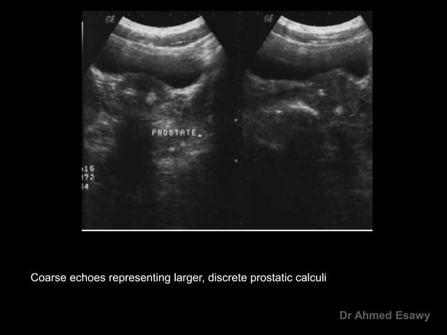 Imaging prostatitis ,urethritis Dr Ahmed Esawy | PDF