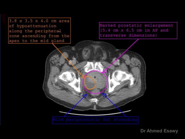 Imaging prostatitis ,urethritis Dr Ahmed Esawy | PDF