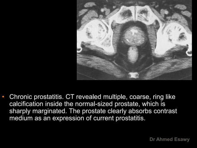 Imaging prostatitis ,urethritis Dr Ahmed Esawy | PDF