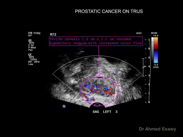 Imaging prostatitis ,urethritis Dr Ahmed Esawy | PDF