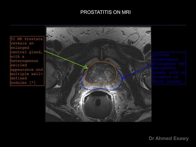 Imaging prostatitis ,urethritis Dr Ahmed Esawy | PDF