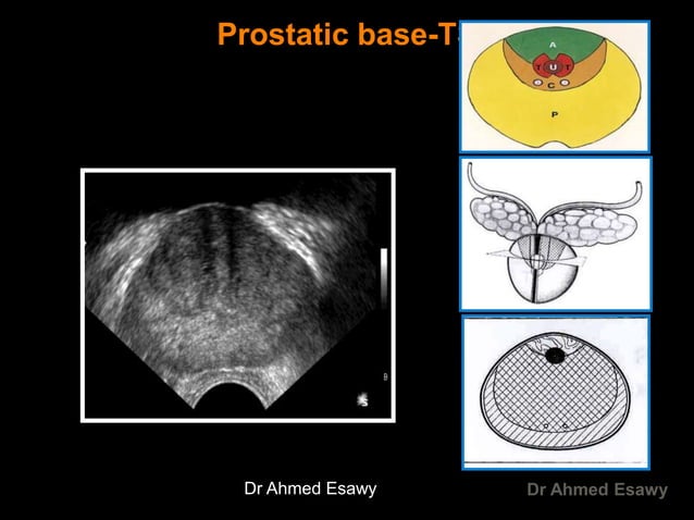 Imaging prostatitis ,urethritis Dr Ahmed Esawy | PDF