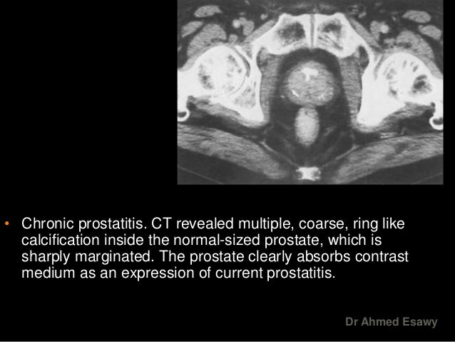 Imaging prostatitis ,urethritis Dr Ahmed Esawy