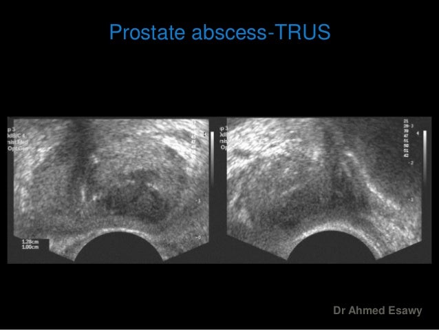 Imaging prostatitis ,urethritis Dr Ahmed Esawy