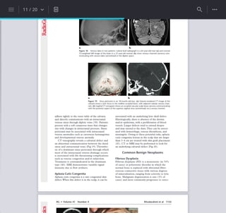 Imaging Spectrum of Calvarial Abnormalities 4.pdf