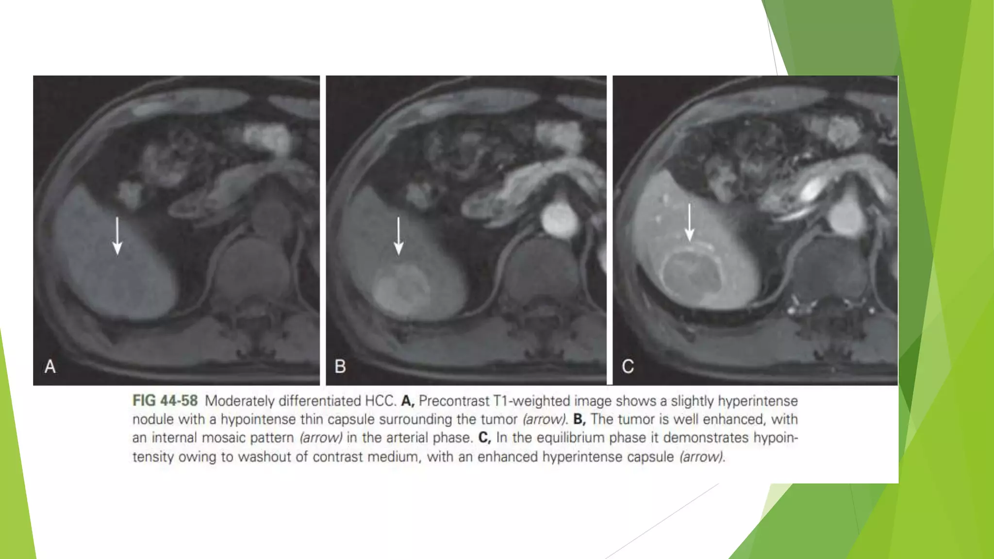 IMAGING SPECTRUM OF HCC | PPTX