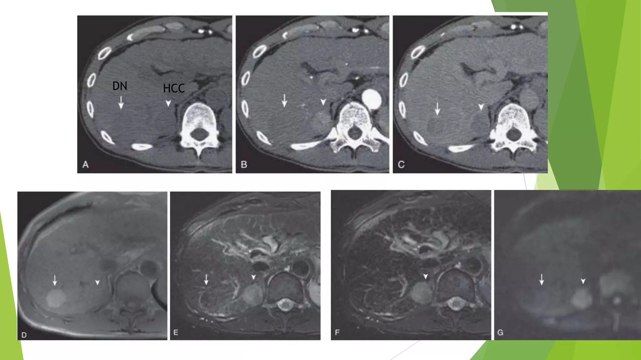 IMAGING SPECTRUM OF HCC | PPTX