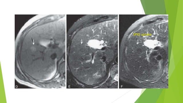 IMAGING SPECTRUM OF HCC | PPT