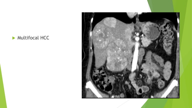 IMAGING SPECTRUM OF HCC | PPT