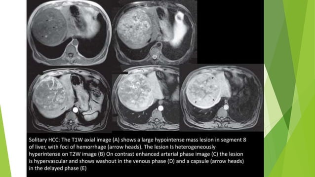 IMAGING SPECTRUM OF HCC | PPT