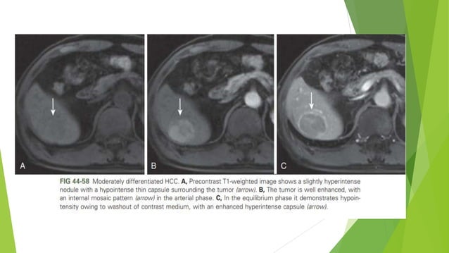 IMAGING SPECTRUM OF HCC | PPT