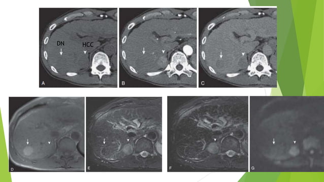 IMAGING SPECTRUM OF HCC | PPT