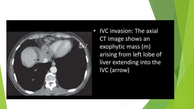 IMAGING SPECTRUM OF HCC | PPT