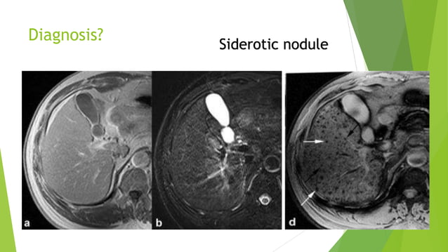 IMAGING SPECTRUM OF HCC | PPT