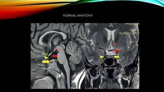 imaging spectrum of sellar and parasellar masses in-1.pptx