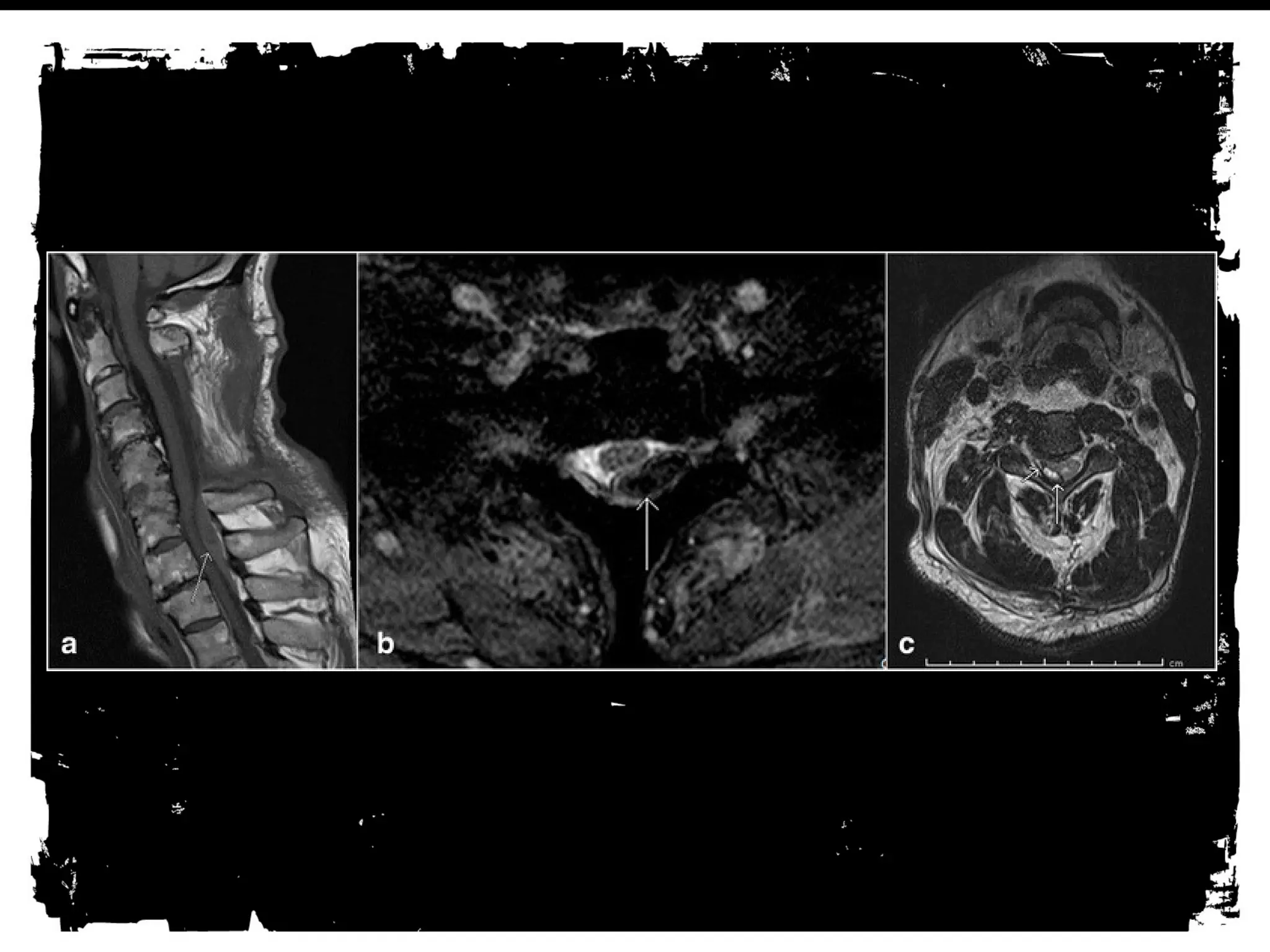 Role of magnetic resonance Imaging in acute spinal trauma | PPT