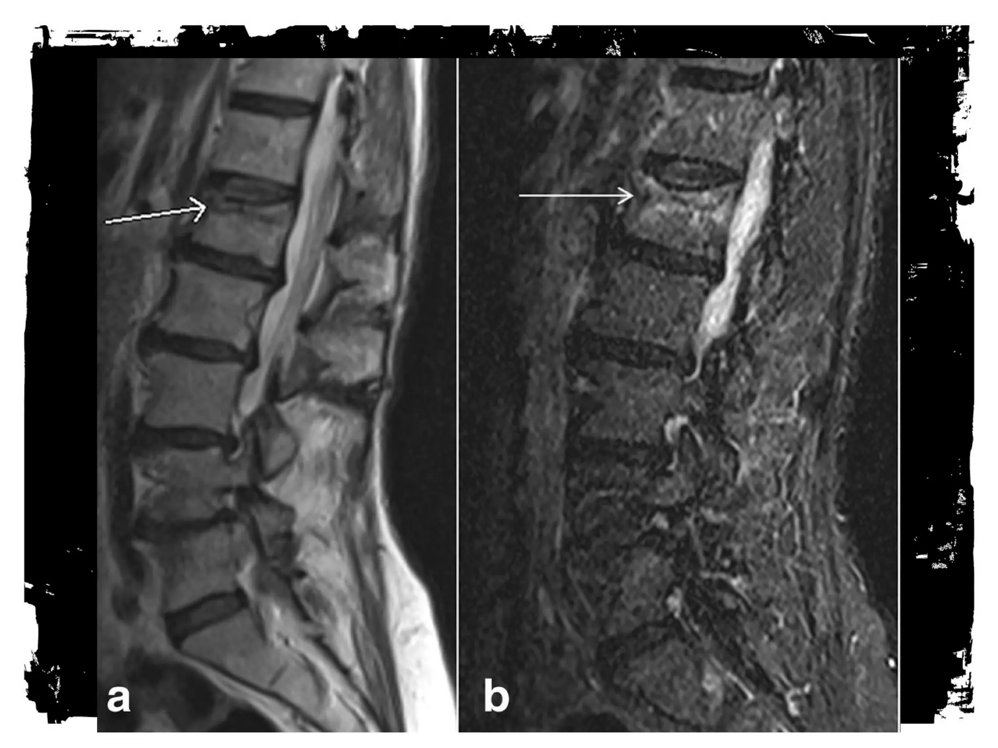Role of magnetic resonance Imaging in acute spinal trauma | PPT