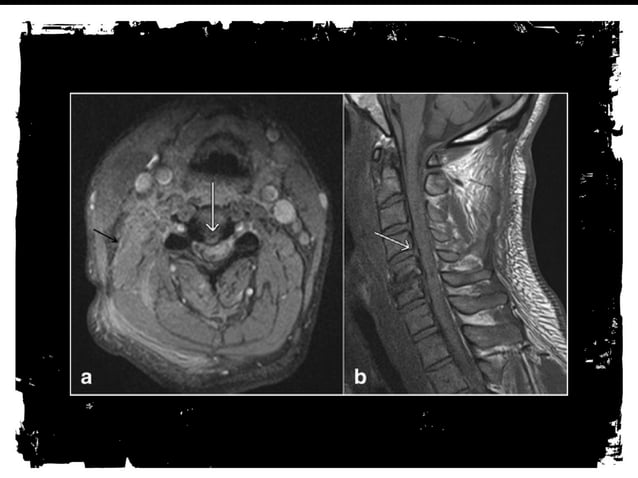 Role of magnetic resonance Imaging in acute spinal trauma | PPT | Death ...