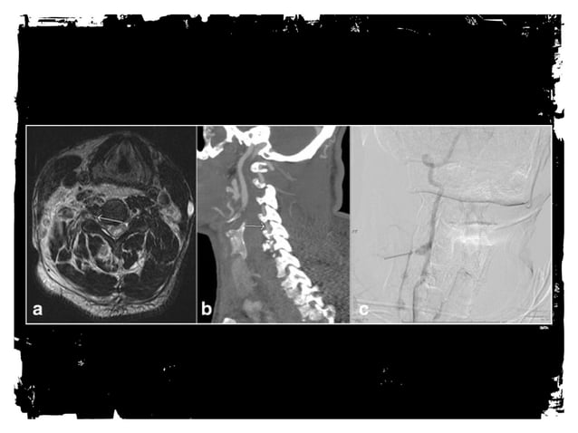 Role of magnetic resonance Imaging in acute spinal trauma | PPT | Death ...