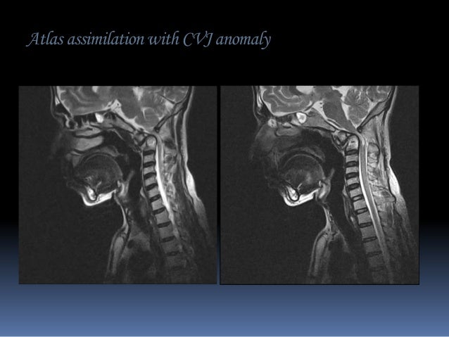 Imaging the cv junction.part 1. himadri s das