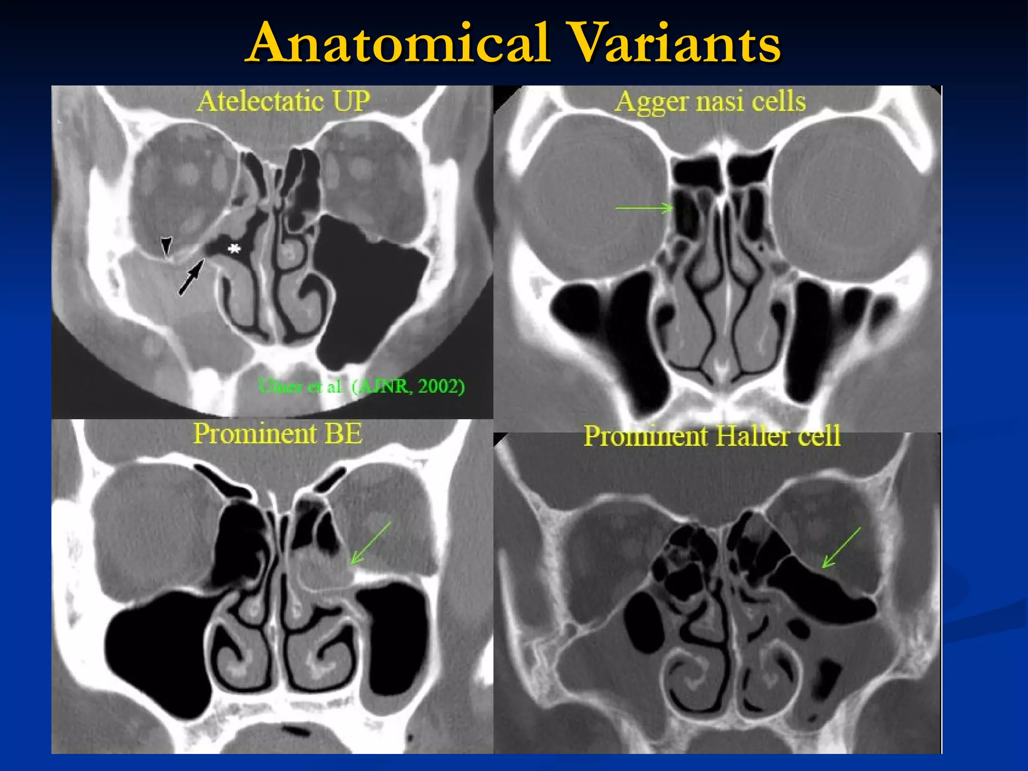 Imaging The Paranasal Sinuses. Iria 2008 | PPT