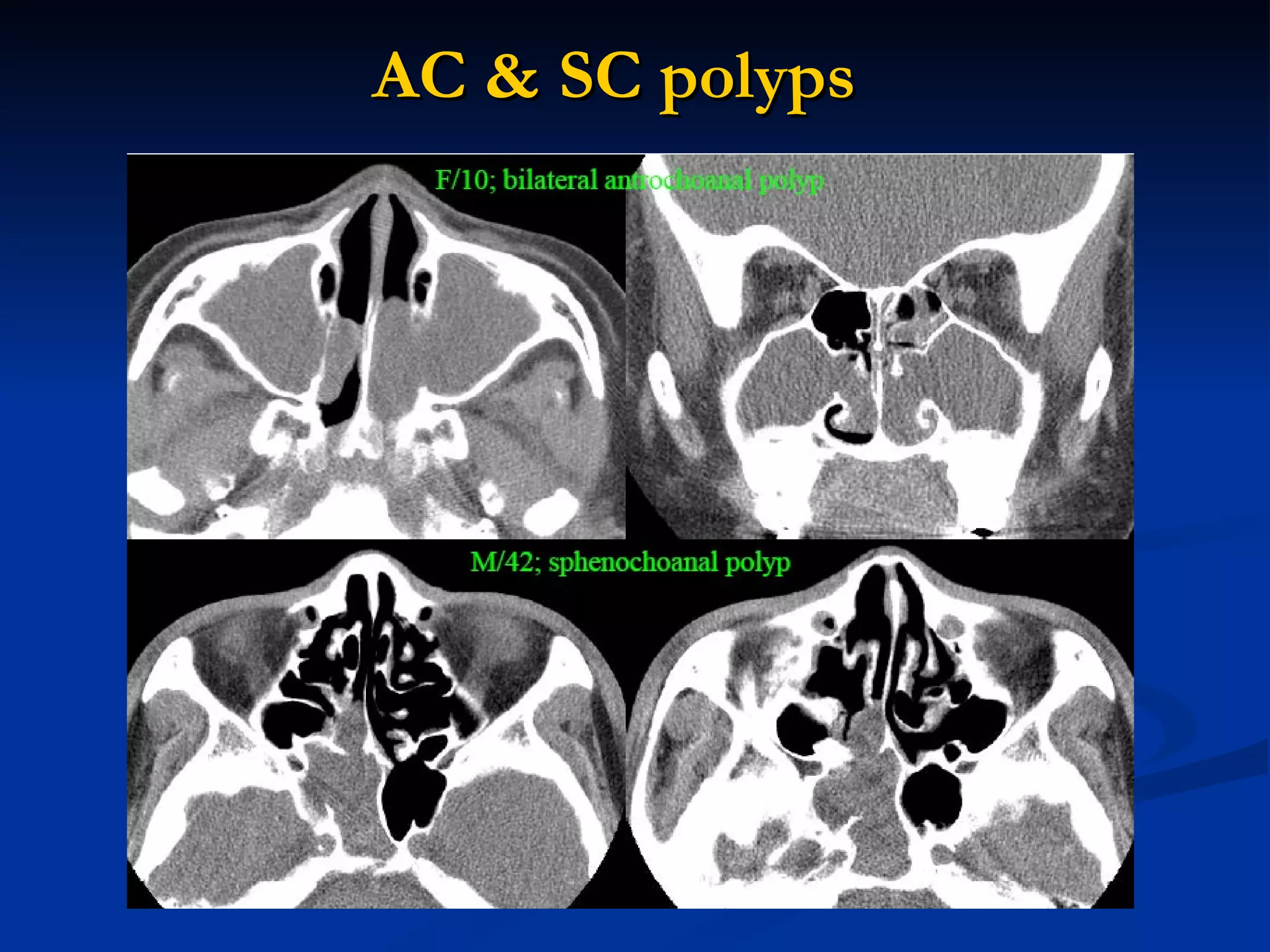 Imaging The Paranasal Sinuses. Iria 2008 | PPT