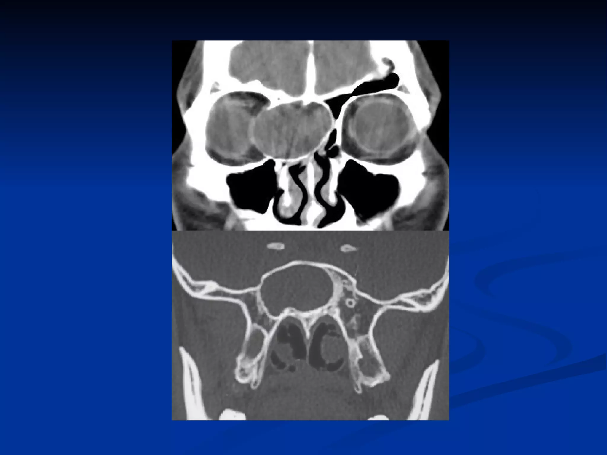 Imaging The Paranasal Sinuses. Iria 2008 | PPT