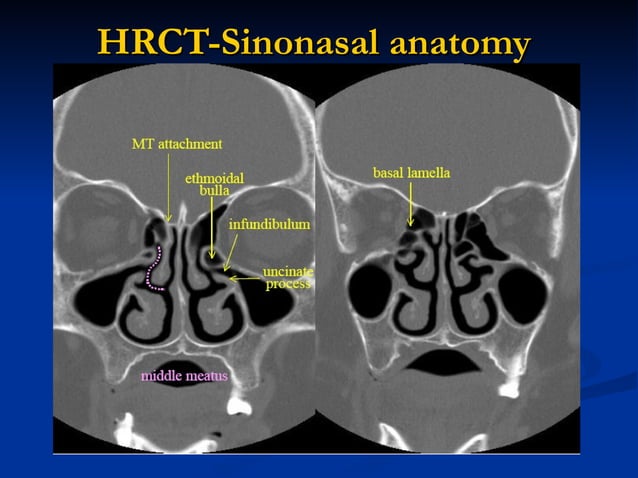 Imaging The Paranasal Sinuses. Iria 2008 | PPT | Ear, Nose and Throat ...