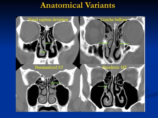 Imaging The Paranasal Sinuses. Iria 2008 | PPT | Ear, Nose and Throat ...