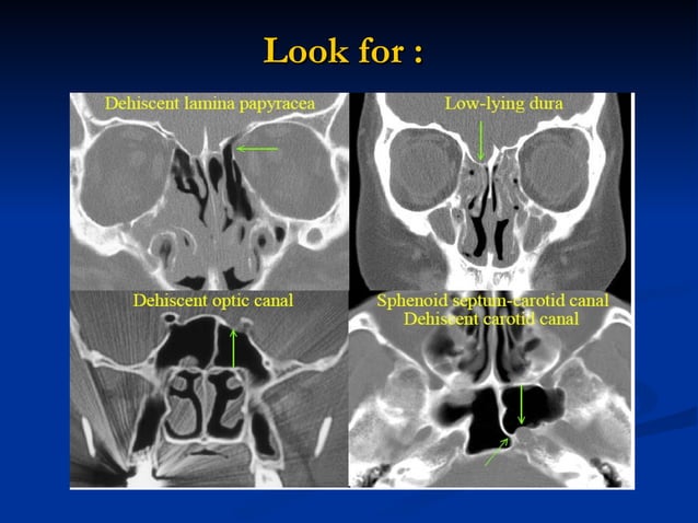 Imaging The Paranasal Sinuses. Iria 2008 | PPT | Ear, Nose and Throat ...