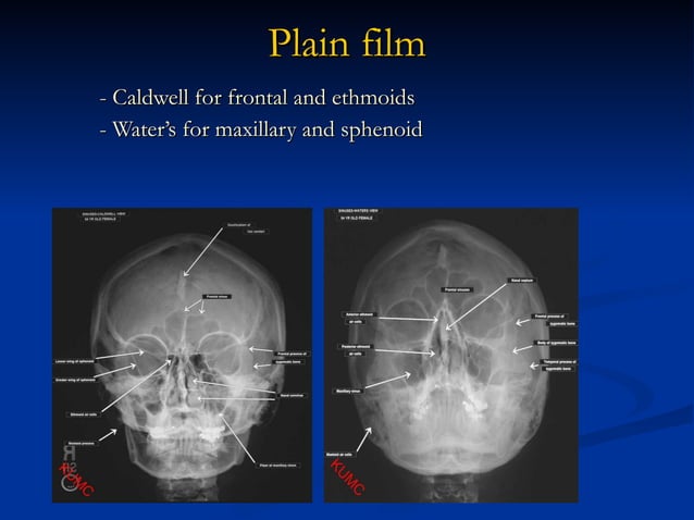 Imaging The Paranasal Sinuses. Iria 2008 | PPT | Ear, Nose and Throat ...