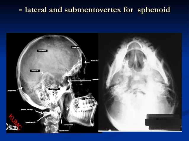 Imaging The Paranasal Sinuses. Iria 2008 | PPT | Ear, Nose and Throat ...