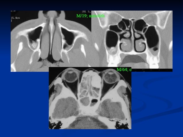 Imaging The Paranasal Sinuses. Iria 2008 | PPT | Ear, Nose and Throat ...