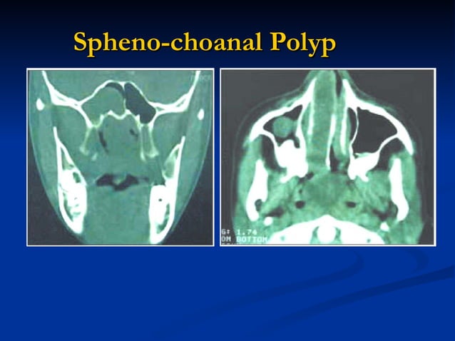 Imaging The Paranasal Sinuses. Iria 2008 | PPT | Ear, Nose and Throat ...