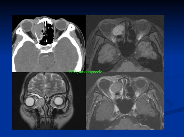 Imaging The Paranasal Sinuses. Iria 2008 | PPT | Ear, Nose and Throat ...