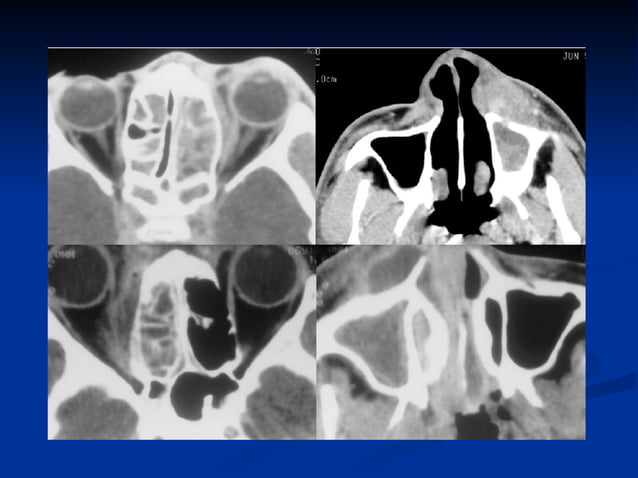 Imaging The Paranasal Sinuses. Iria 2008 | PPT | Ear, Nose and Throat ...