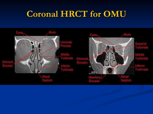 Imaging The Paranasal Sinuses. Iria 2008 | PPT | Ear, Nose and Throat ...