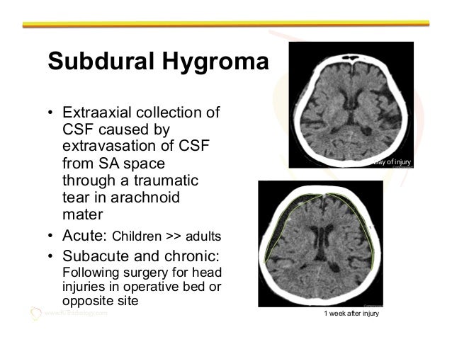 Imaging of the traumatic brain injury by Rathachai Kaewlai, MD