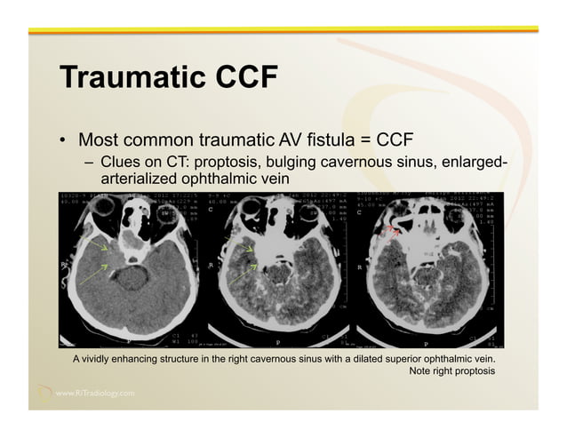 Imaging of Traumatic Brain Injury | PPT