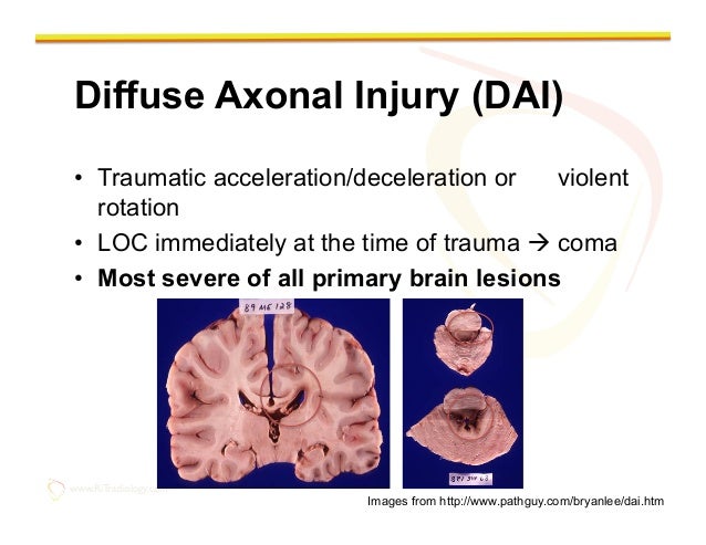Imaging of Traumatic Brain Injury