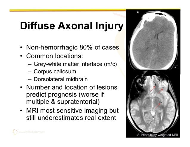 Imaging of Traumatic Brain Injury