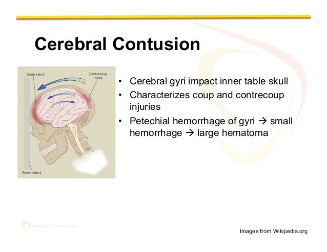 Imaging of Traumatic Brain Injury