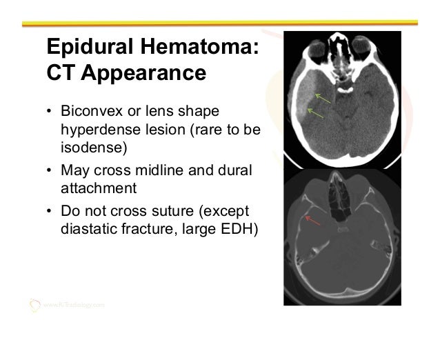Imaging of Traumatic Brain Injury
