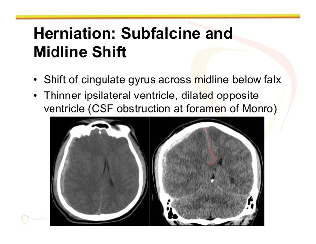 Imaging of Traumatic Brain Injury