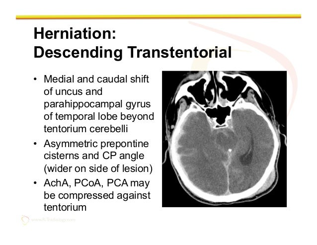 Imaging of Traumatic Brain Injury