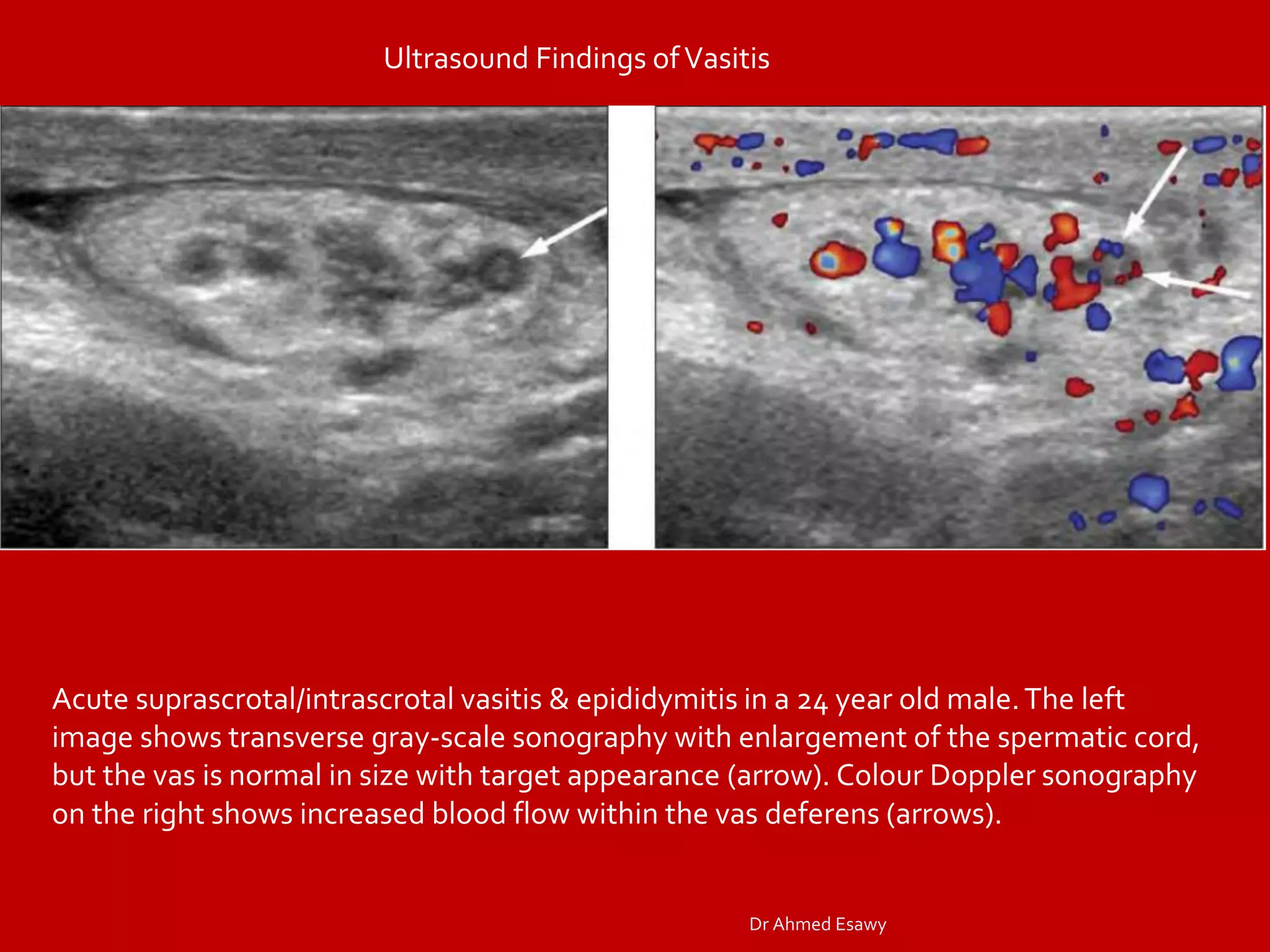 Imaging vastitis differentitis funiculitis seminal vesiculitis Dr Ahmed ...