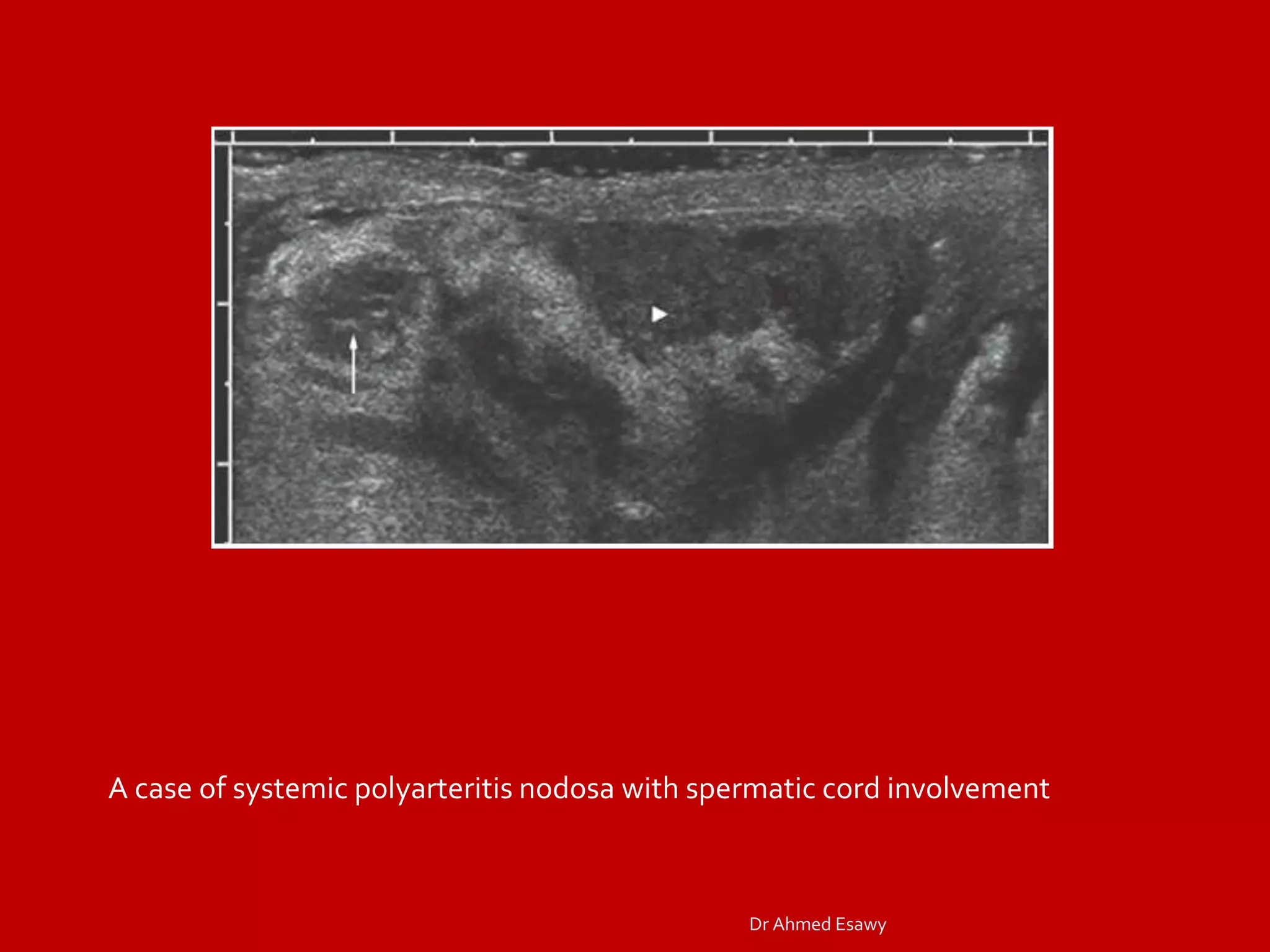 Imaging vastitis differentitis funiculitis seminal vesiculitis Dr Ahmed ...