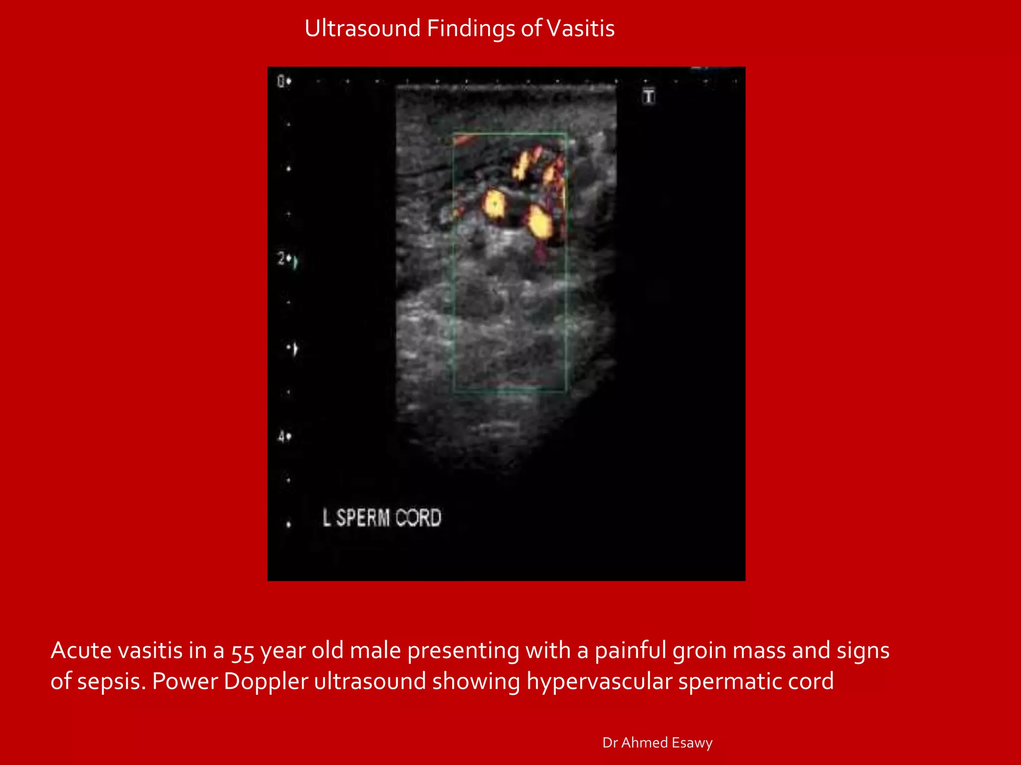 Imaging vastitis differentitis funiculitis seminal vesiculitis Dr Ahmed ...