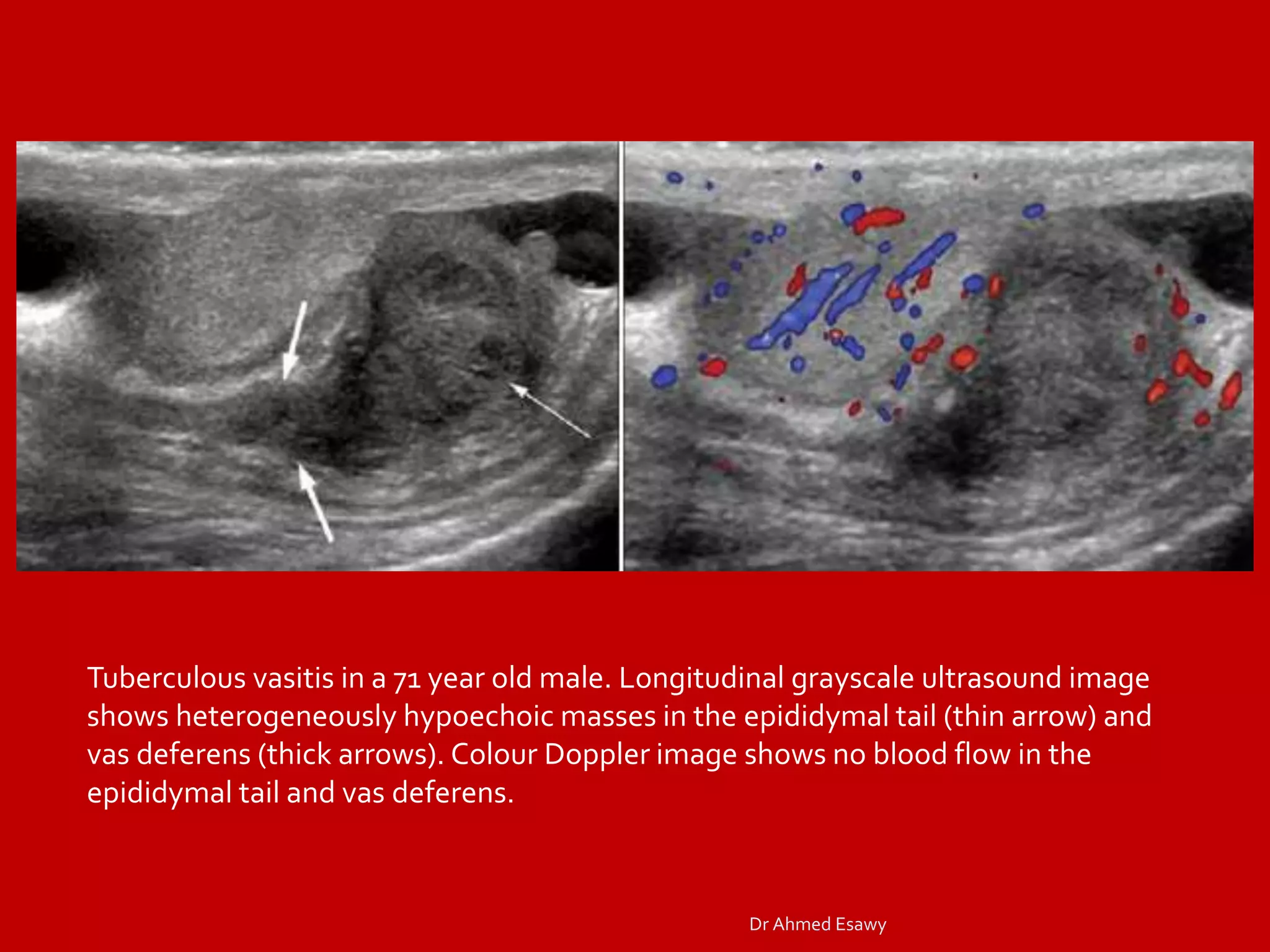 Imaging vastitis differentitis funiculitis seminal vesiculitis Dr Ahmed ...