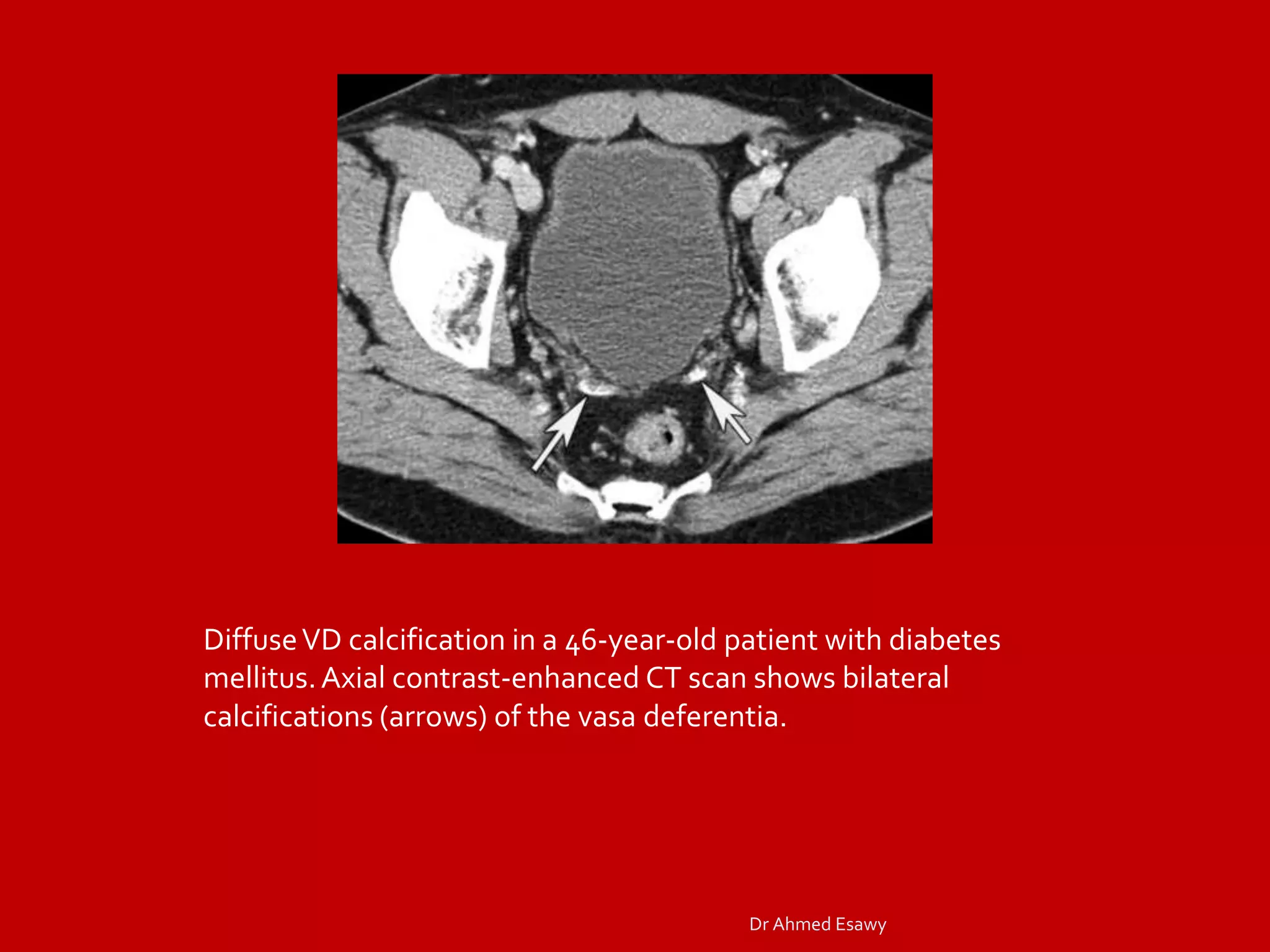Imaging vastitis differentitis funiculitis seminal vesiculitis Dr Ahmed ...